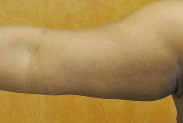 Arm Lift Brachioplasty | Milwaukee | Zelko Aesthetics
