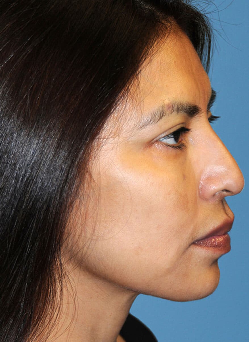 Y Lift (Facelift) | Zelko Aesthetics