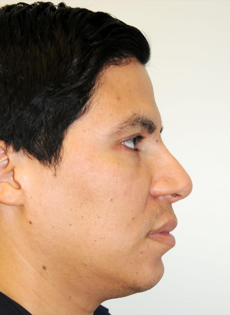 Y Lift (Facelift) | Zelko Aesthetics